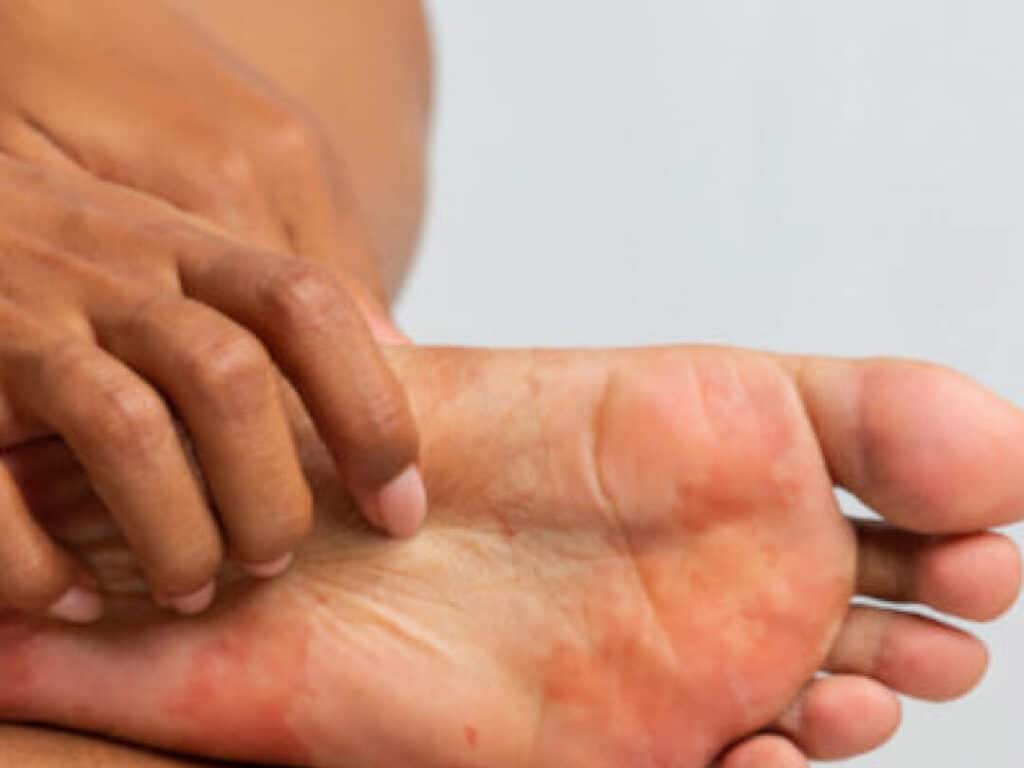 Hongos en los pies: todo sobre el pie de atleta, síntomas y prevención