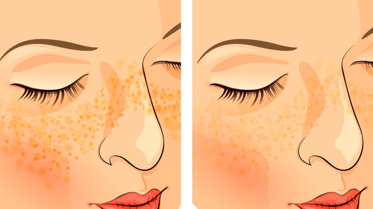 Manchas solares en la piel: prevención y tratamiento eficaz